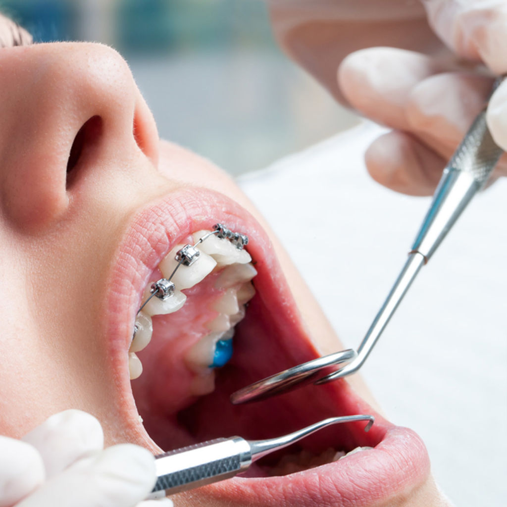 Ortodontia - Odonto Clínica Florianópolis